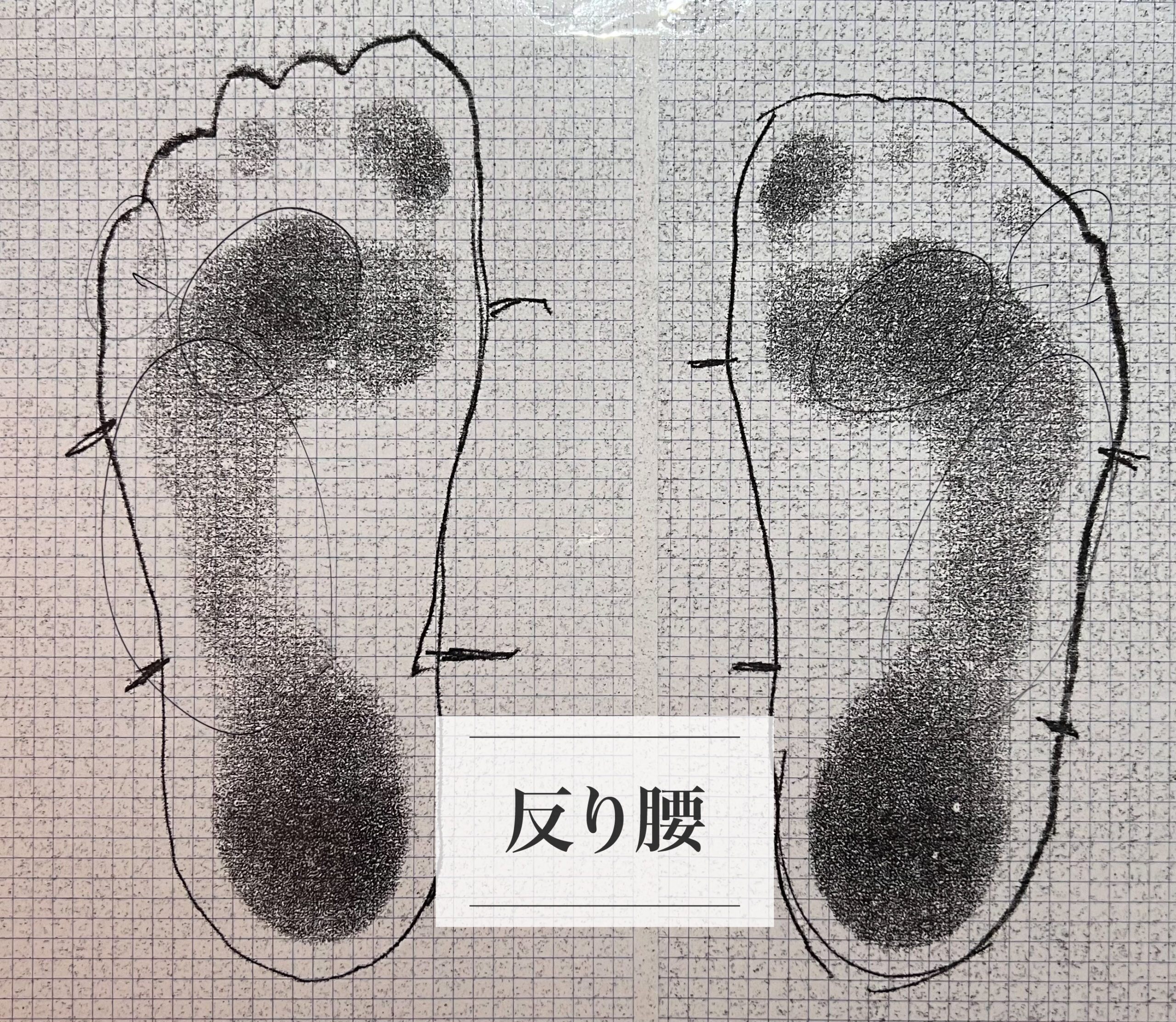 反り腰 女性 | オーダーメイドインソール・フットケア製品制作・販売 ｜ Ayoi株式会社