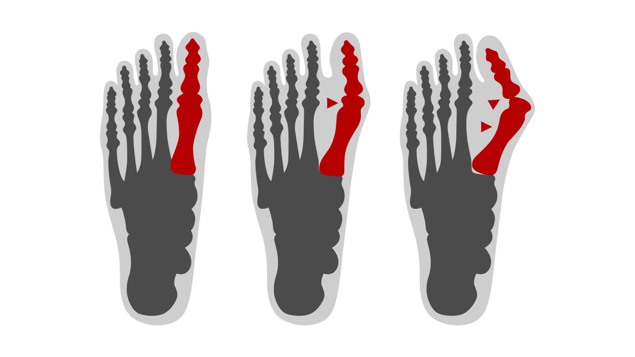 外反母趾の原因とは｜主な原因と改善方法を解説 | オーダーメイドインソール・フットケア製品制作・販売 ｜ Ayoi株式会社